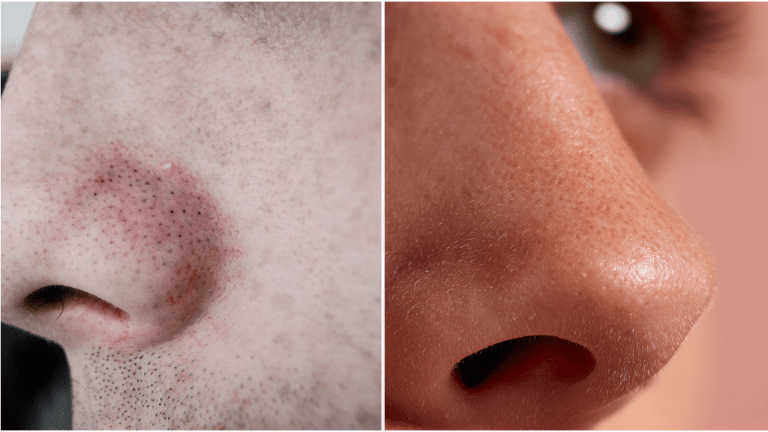Sebaceous Filaments vs Blackheads: The Real Difference - Copenhagen ...