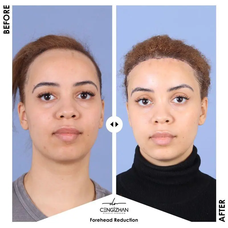 Best Forehead Reduction Surgery in Turkey: How Dr. Cengizhan Is ...